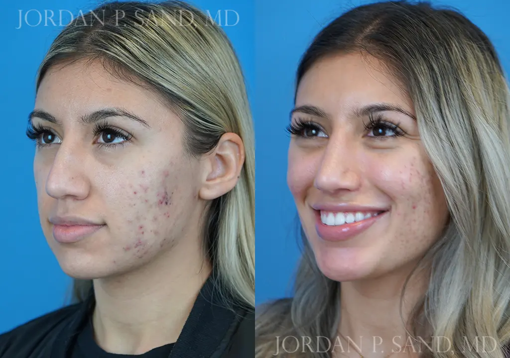 5 Uses of IPL (Intense Pulsed Light) Treatment - Sand Plastic Surgery ...
