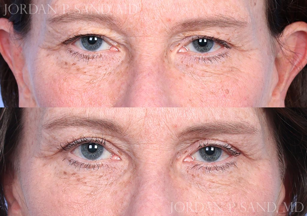 Eye Patient 1 - Sand Plastic Surgery of Spokane
