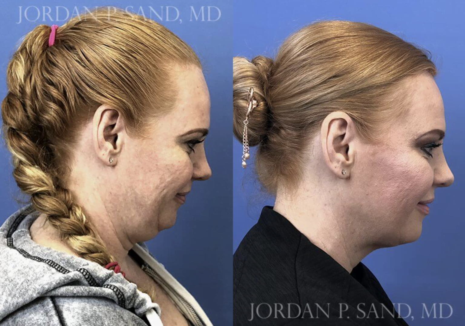 Scarless Facelift with FaceTite - FaceTite and BodyTite